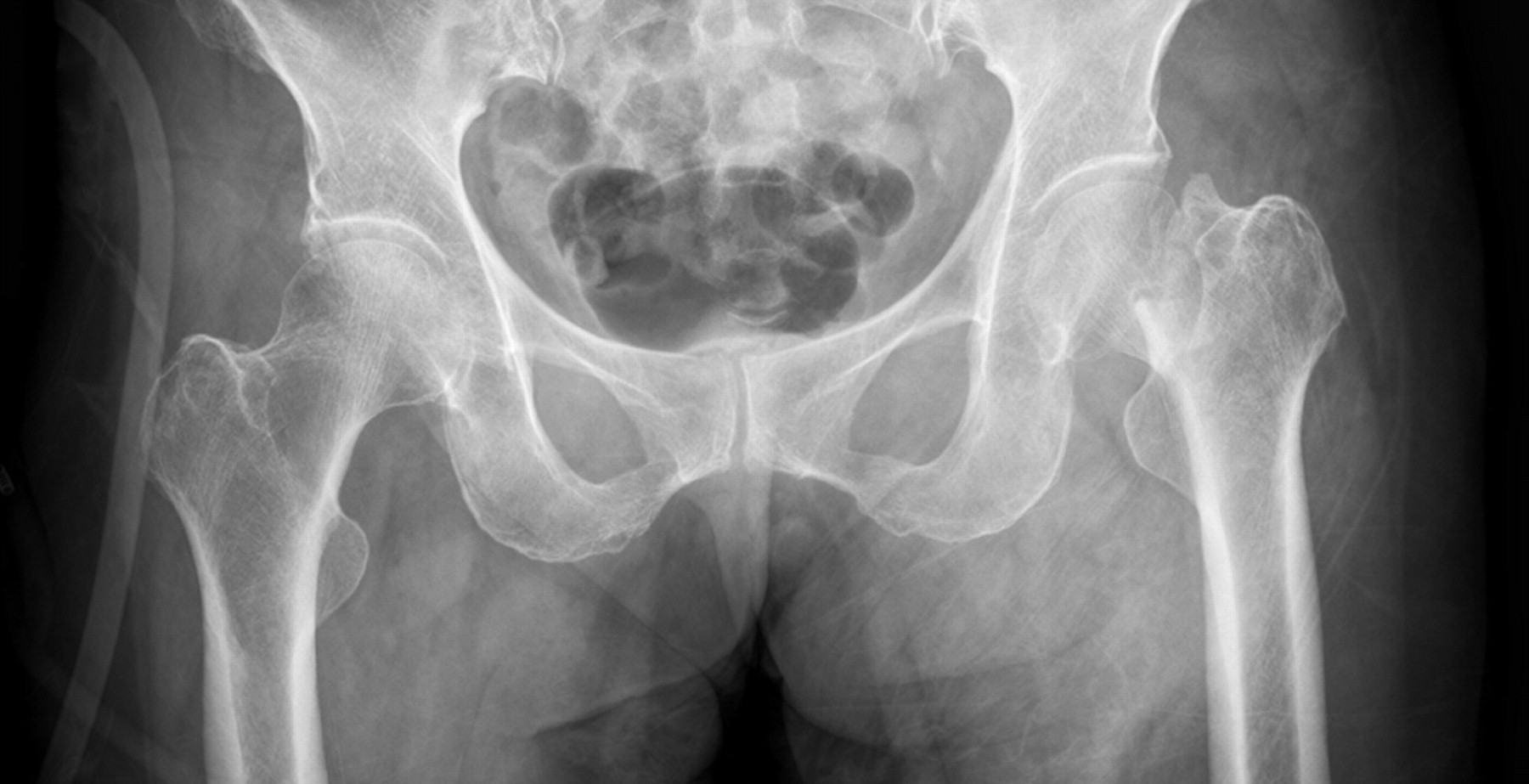 FRAKTUR.dk | Ortopædkirurgisk Forum